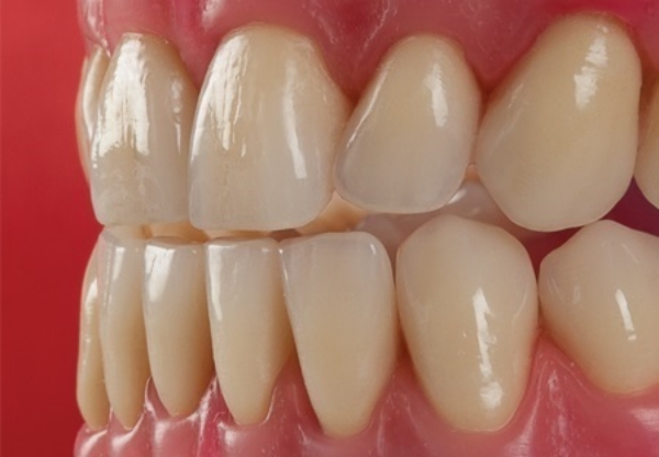 Axsys Dental Solutions. REF-LINE Upper Anterior Teeth