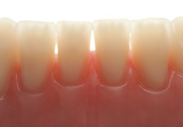 Axsys Dental Solutions. REF-LINE Upper Anterior Teeth